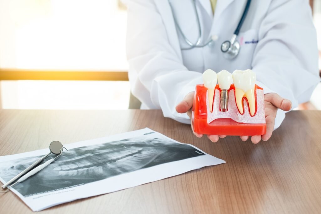 What Are Transnasal Dental Implants?